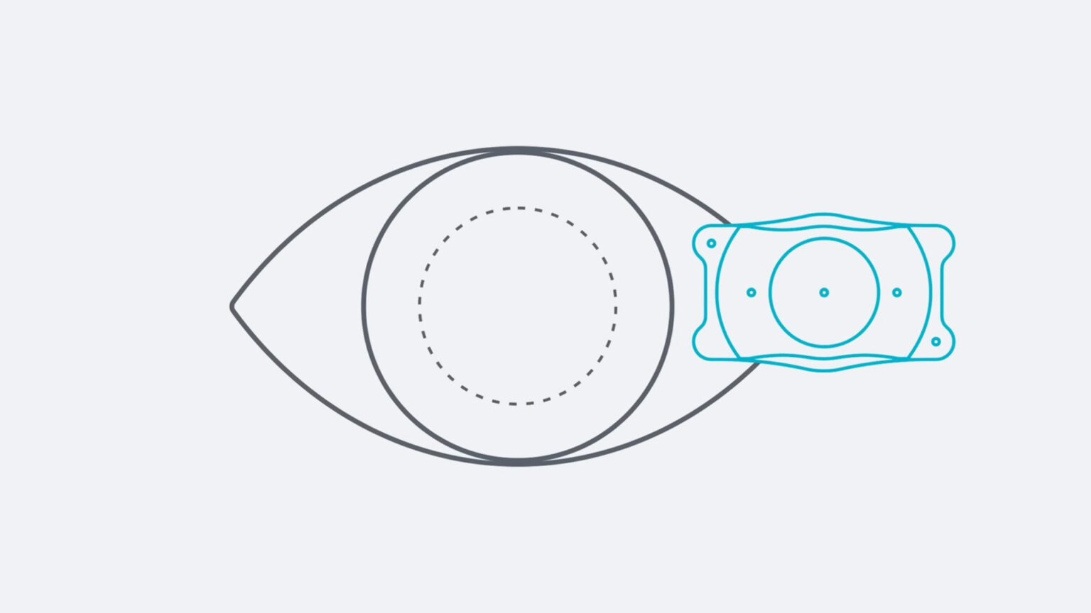 Implantable Collamer Lens – Alternative to LASIK Eye Surgery