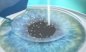LASIK Offers in Dubai for 2025